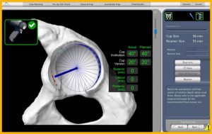 Total Hip Replacement (Robotic, Anterior) - Dr John Limbers